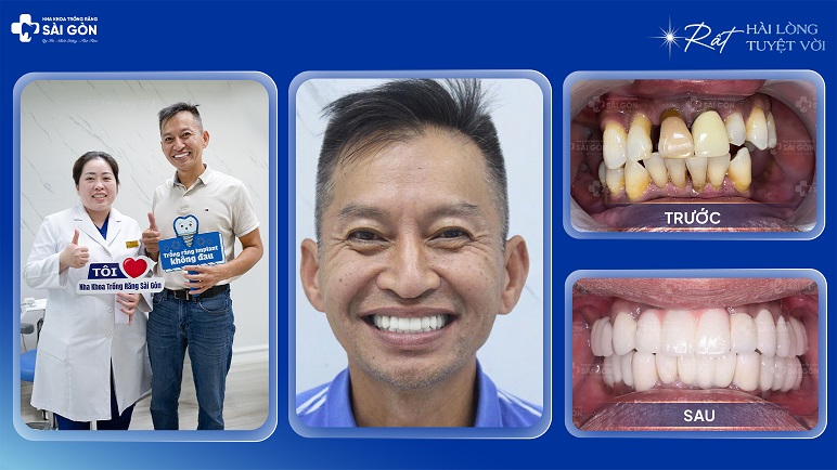 Dual-Jaw Implant Treatment: How Mr. Doan Thanh Son Regained A Natural ...